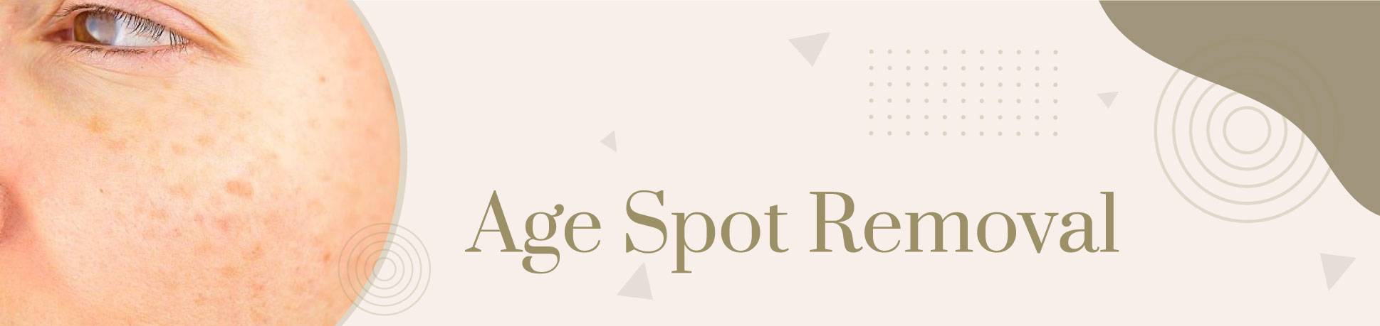 Age Spot Removal | Dermal Filler Harpenden | Harley Street Clinic
