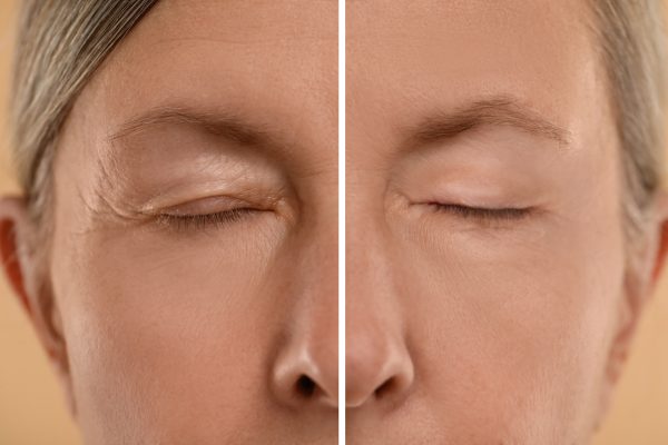Blepharoplasty in Reigate | Upper & Lower Eyelid Surgery Surrey
